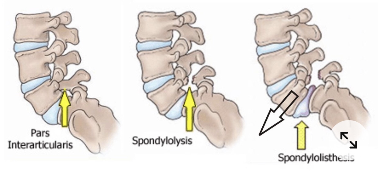 Living with Spondylolysis and Spondylolisthesis – Joint Purpose